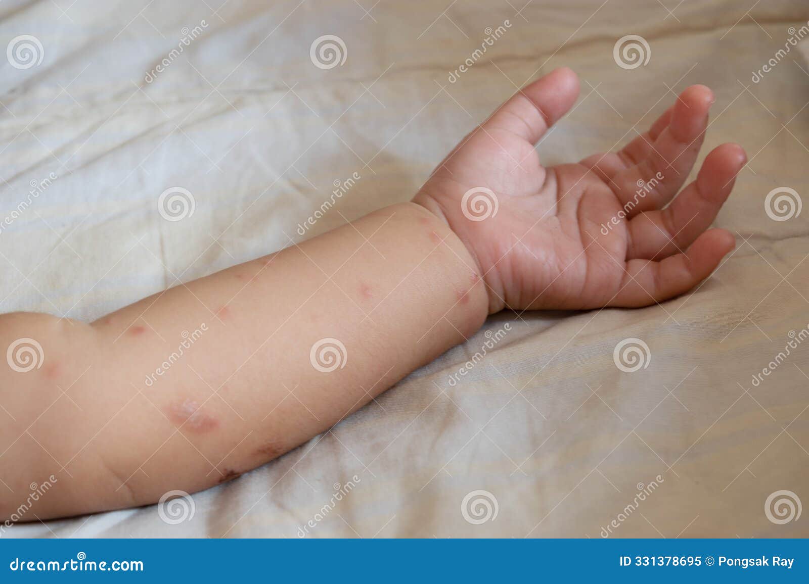 Red Rash Caused by Infant Arm Infection Stock Image - Image of infant ...