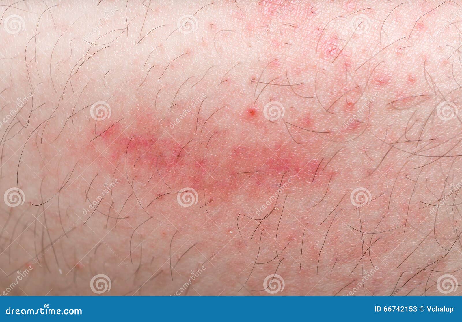 Red rush on leg skin stock image. Image of medicare, skin - 66742153