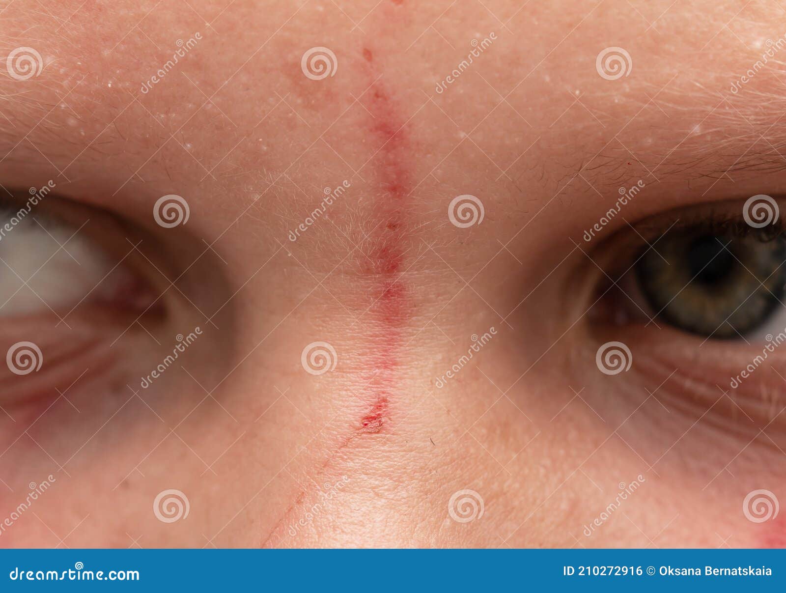 Red scratch on the face stock photo. Image of damaged - 210272916