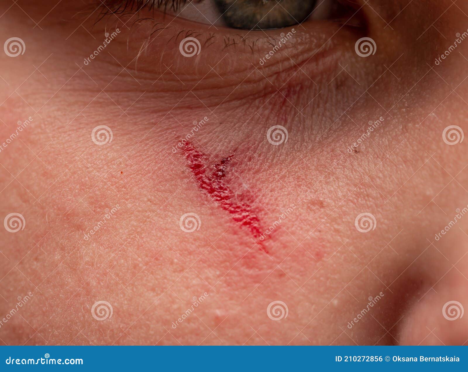 Red scratch on the face stock photo. Image of blood - 210272856