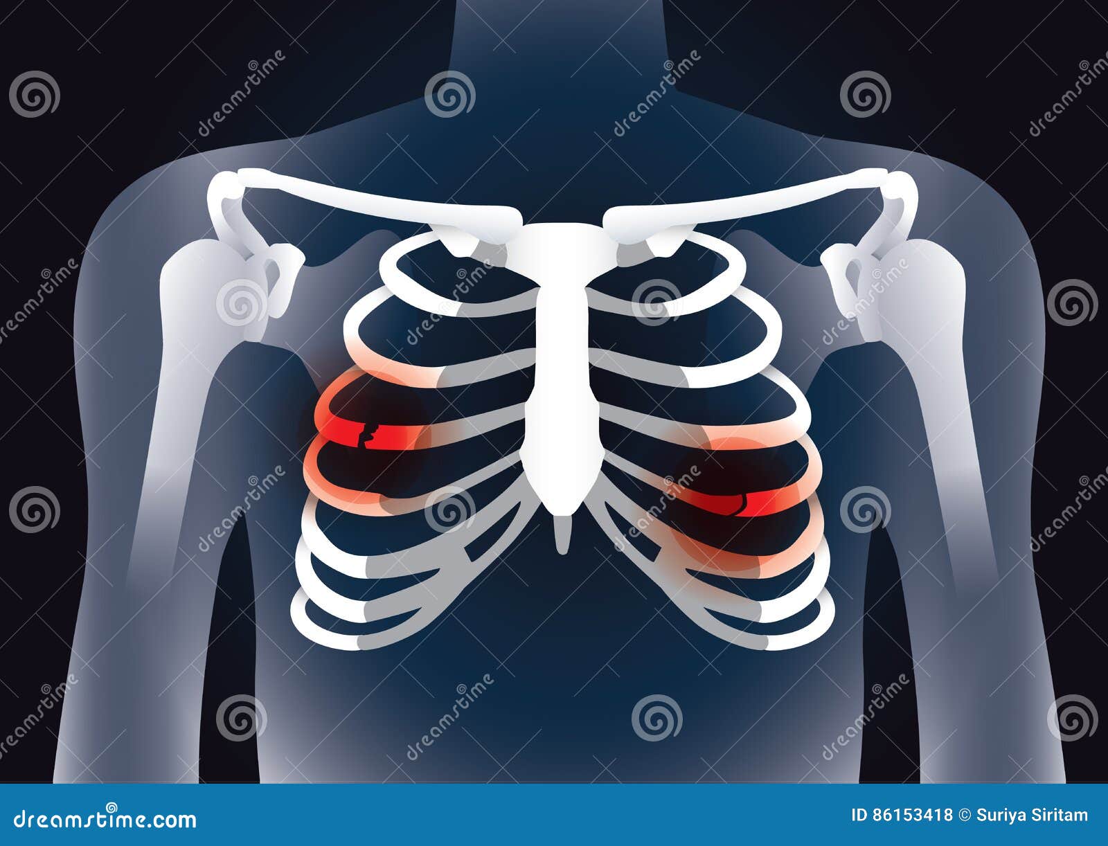 Red Signal at the Bones in Rib Cage Break. Stock Vector - Illustration ...