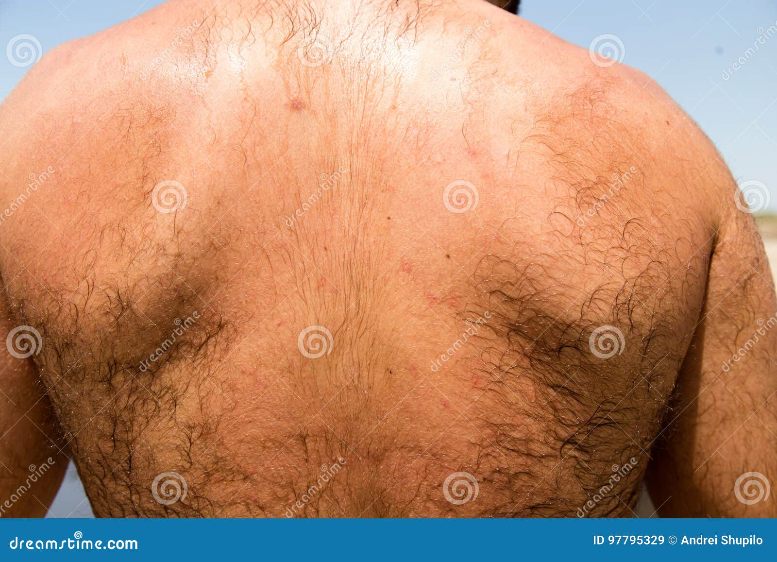 Red Skin Tan on the Back of a Man Stock Image - Image of peeling ...