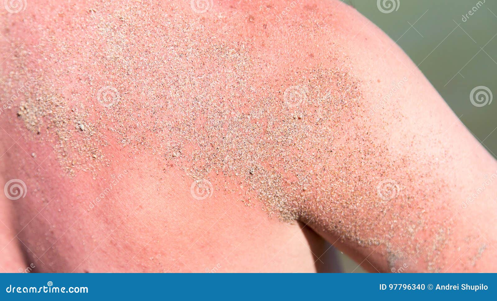 Red Skin Tan on the Back of a Man Stock Photo - Image of protection ...