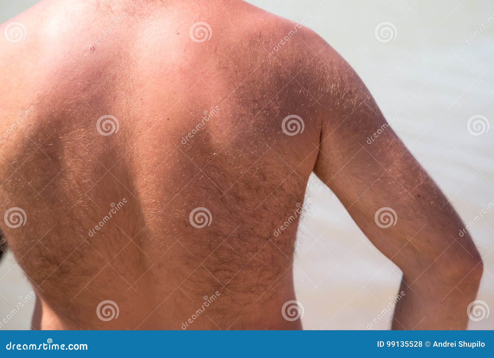 Red Skin Tan on the Back of a Man Stock Photo - Image of protection ...