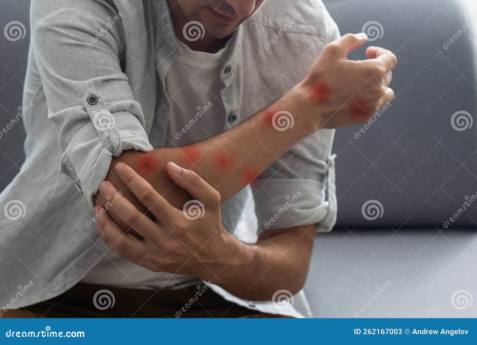 Red spots on the hands stock image. Image of rash, patient - 262167003