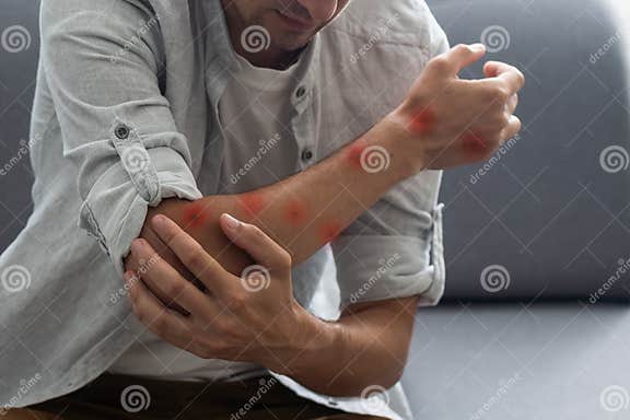 Red spots on the hands stock image. Image of rash, patient - 262167003