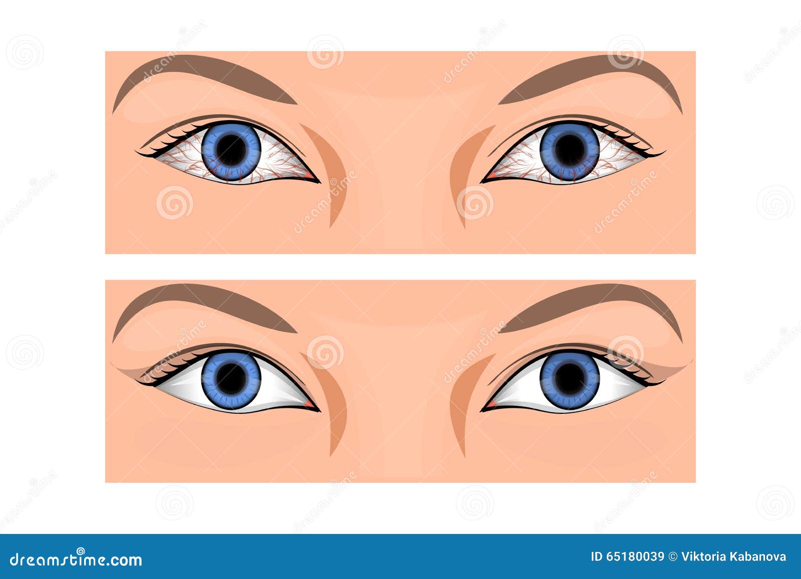 Conjunctivitis Allergic Inflammation Of Vision Eye Vector Illustration ...