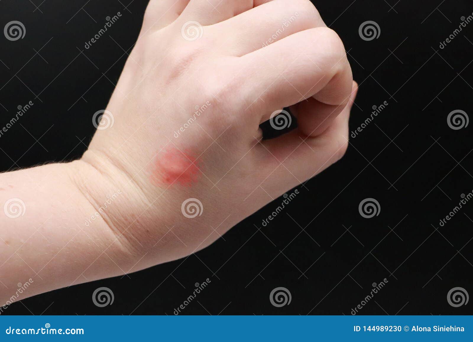 Redness and Itching on the Arm. the Doctor Examines the Hand on Which ...