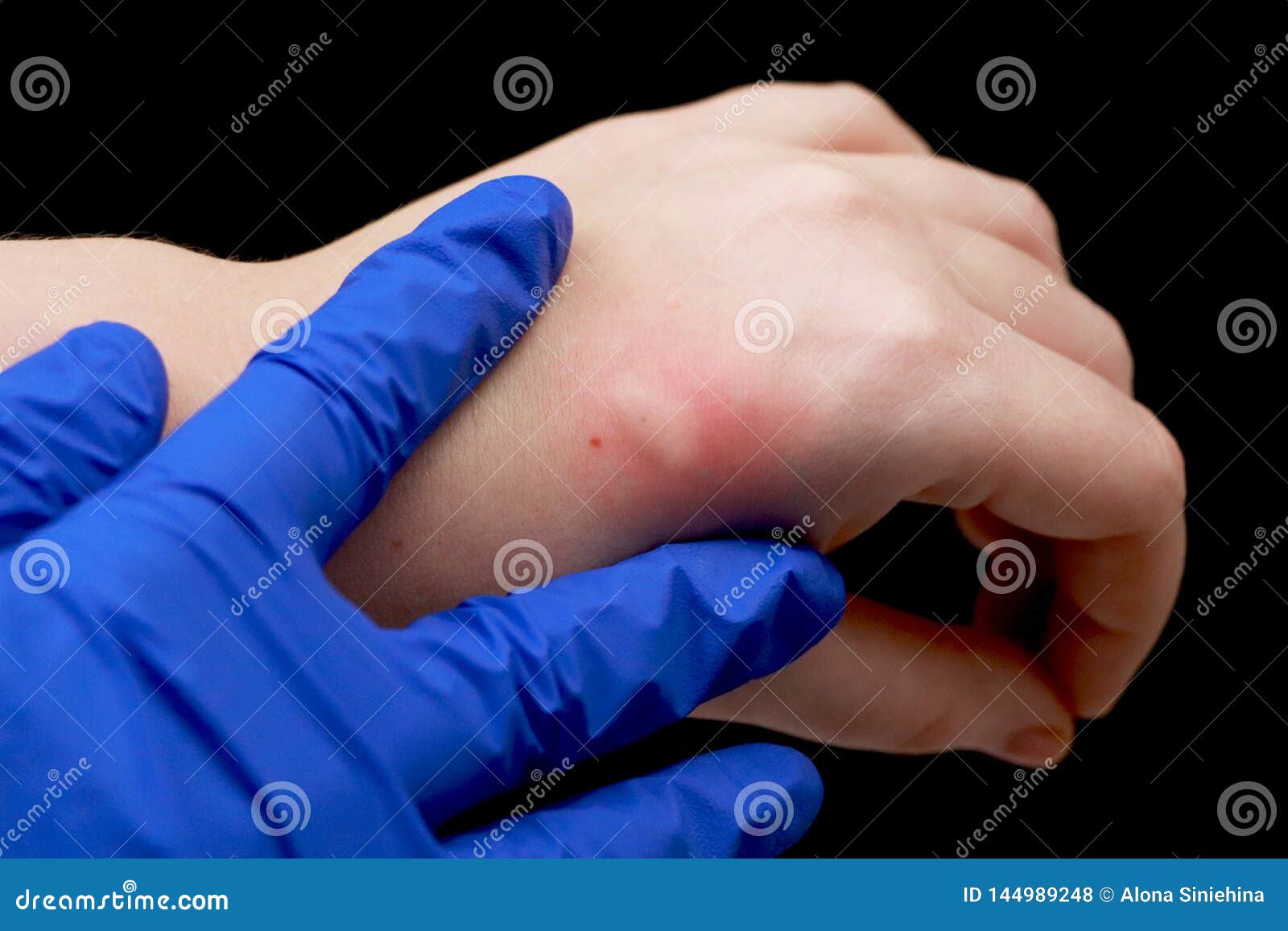 Redness and Itching on the Arm. the Doctor Examines the Hand on Which ...