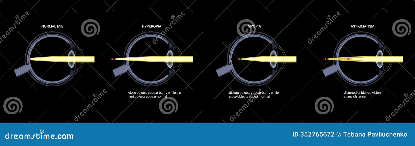 Myopia, Short Sighted Eye Cartoon Vector | CartoonDealer.com #52791175