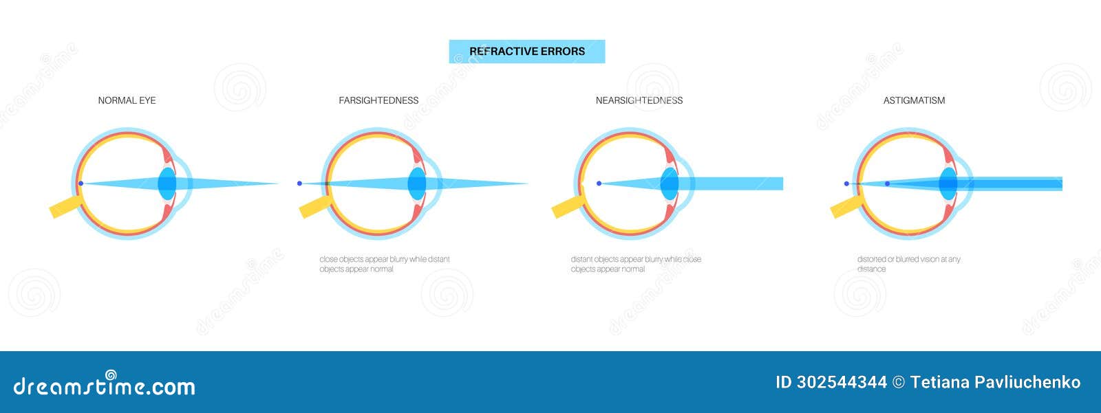 Astigmatism Disorder Medical Illustration | CartoonDealer.com #308476378