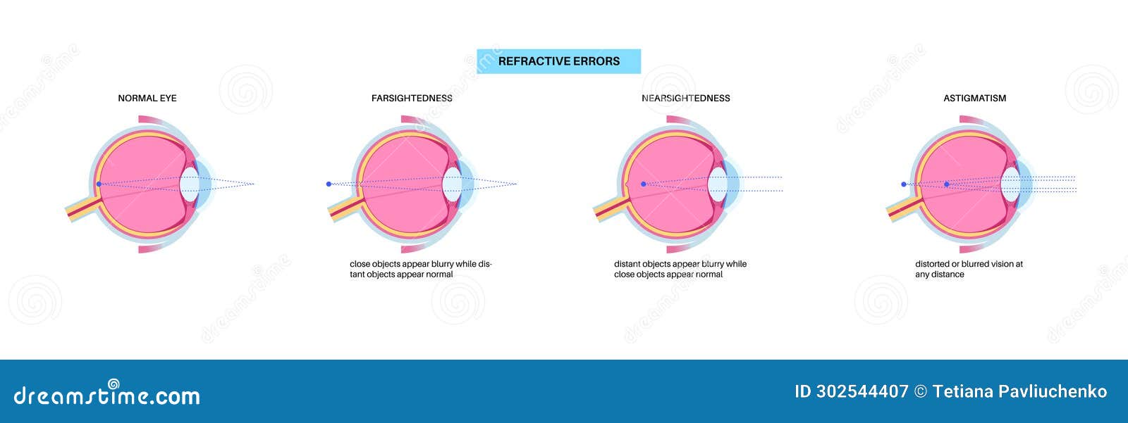 Refractive errors poster stock vector. Illustration of farsightedness ...