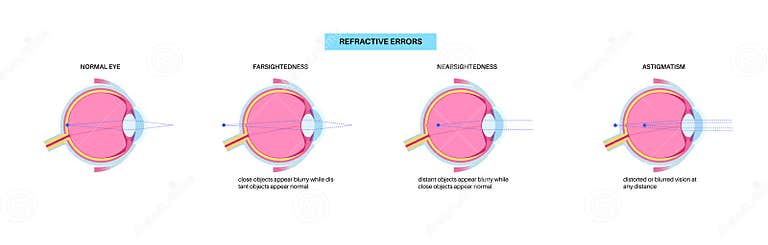 Refractive errors poster stock vector. Illustration of farsightedness ...