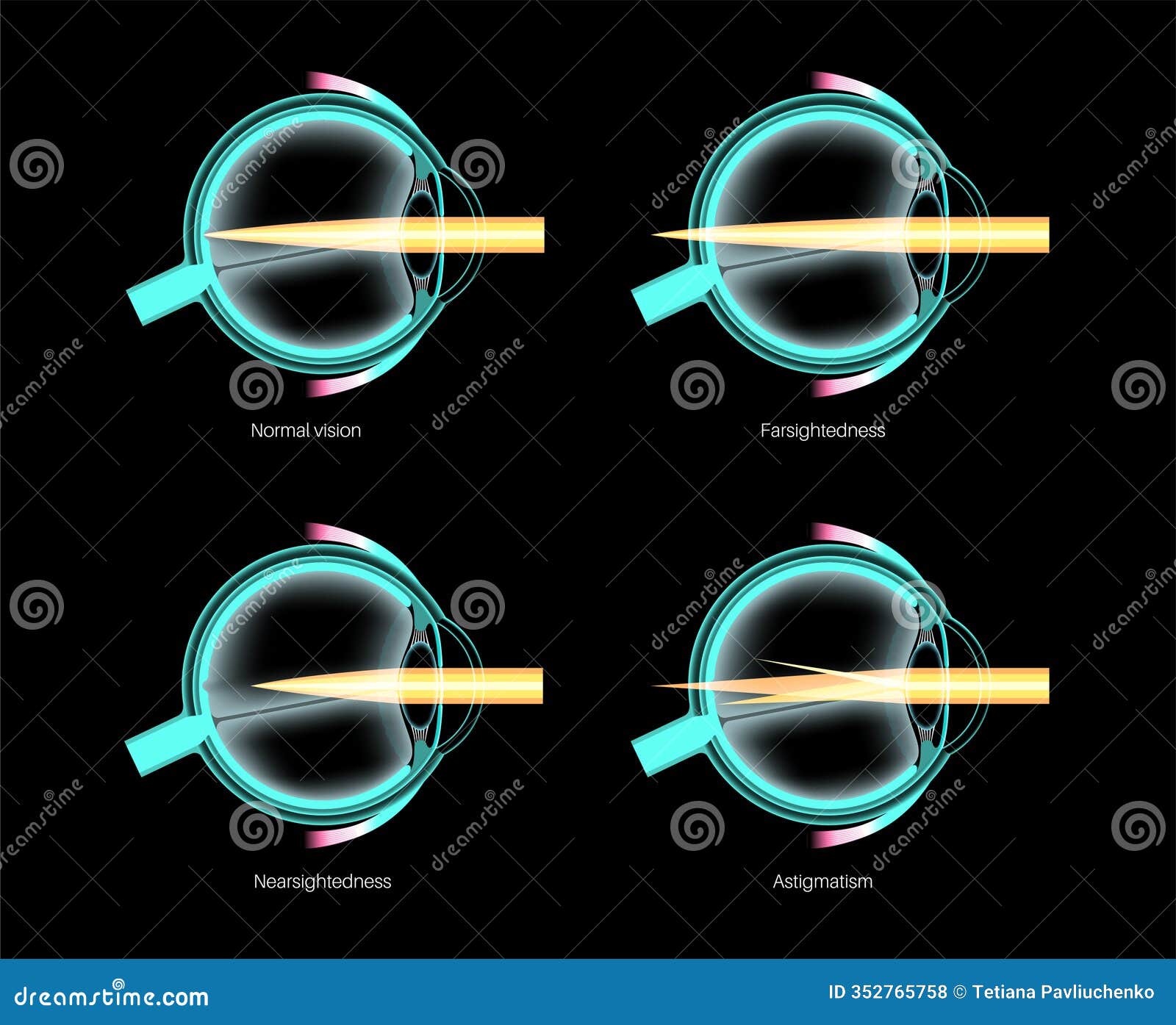 Myopia, Short Sighted Eye Cartoon Vector | CartoonDealer.com #52791175