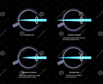 Refractive errors poster stock illustration. Illustration of short ...