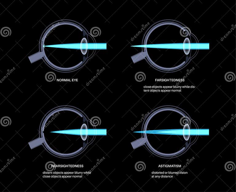 Refractive errors poster stock illustration. Illustration of short ...