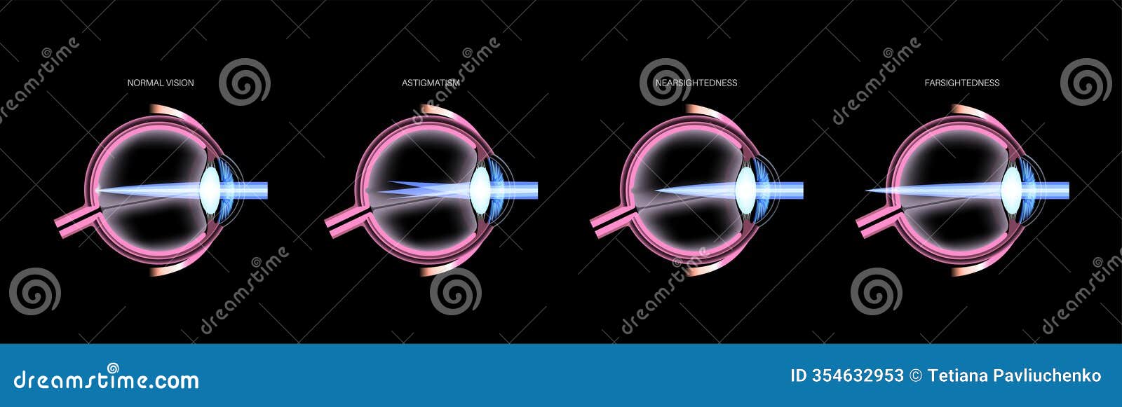 Myopia, Short Sighted Eye Cartoon Vector | CartoonDealer.com #52791175