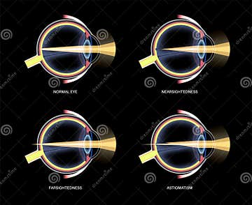 Refractive errors poster stock illustration. Illustration of vector ...