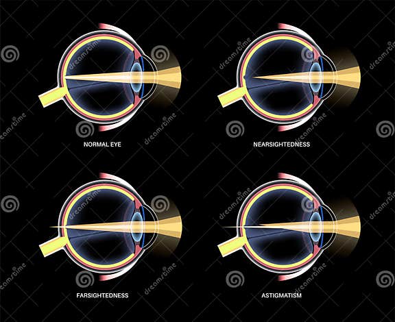 Refractive errors poster stock illustration. Illustration of vector ...