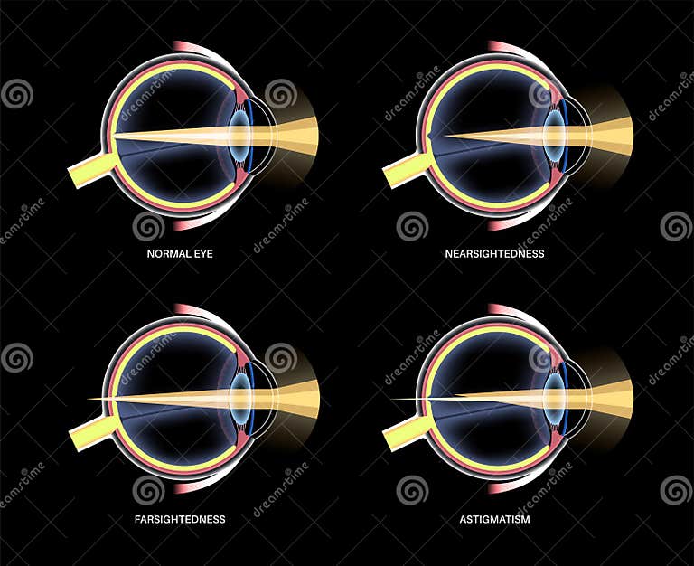 Refractive errors poster stock illustration. Illustration of vector ...