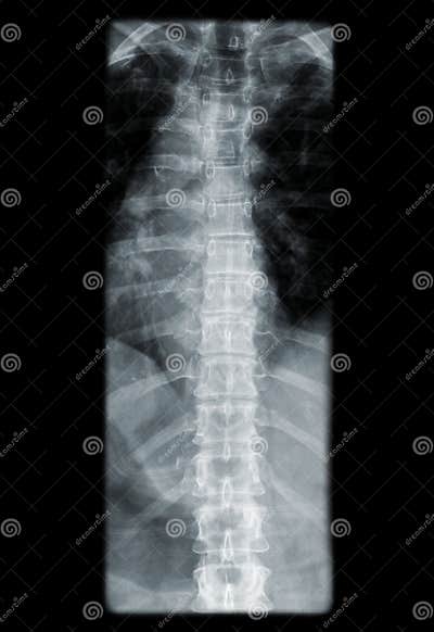 Regular Spine on Black Background Stock Photo - Image of bone, person ...