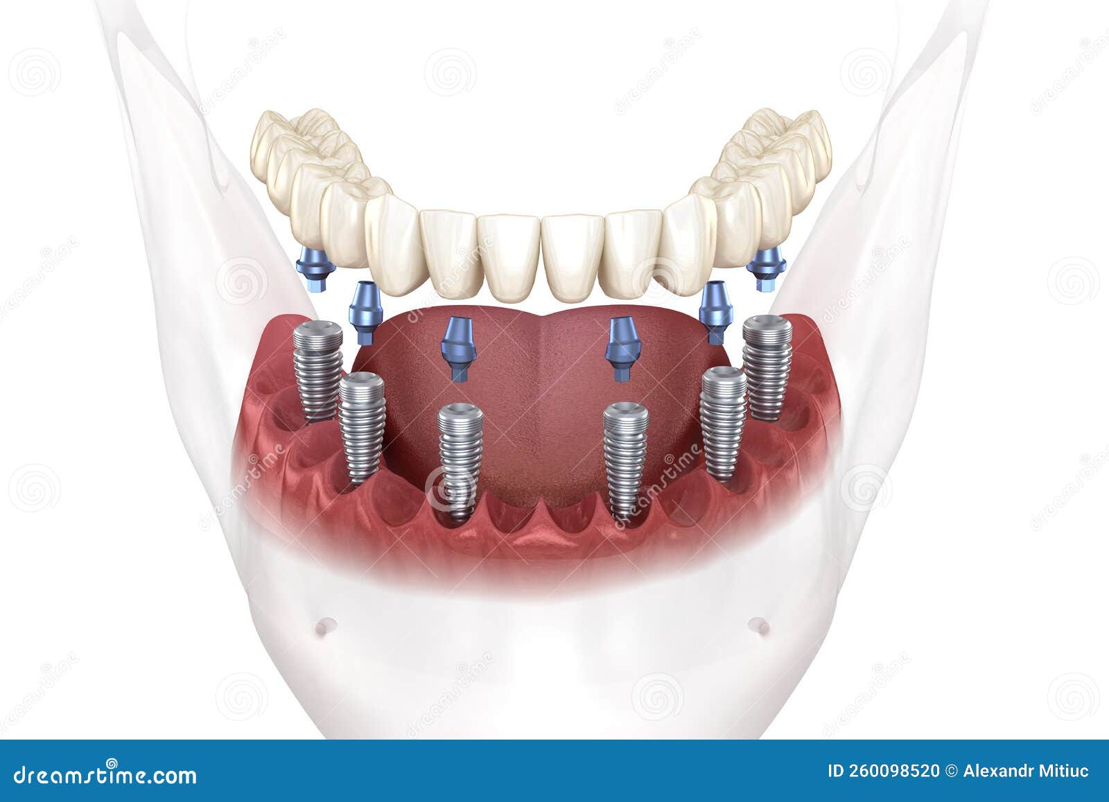 Removable Mandibular Prosthesis All on 6 System Supported by Implants ...