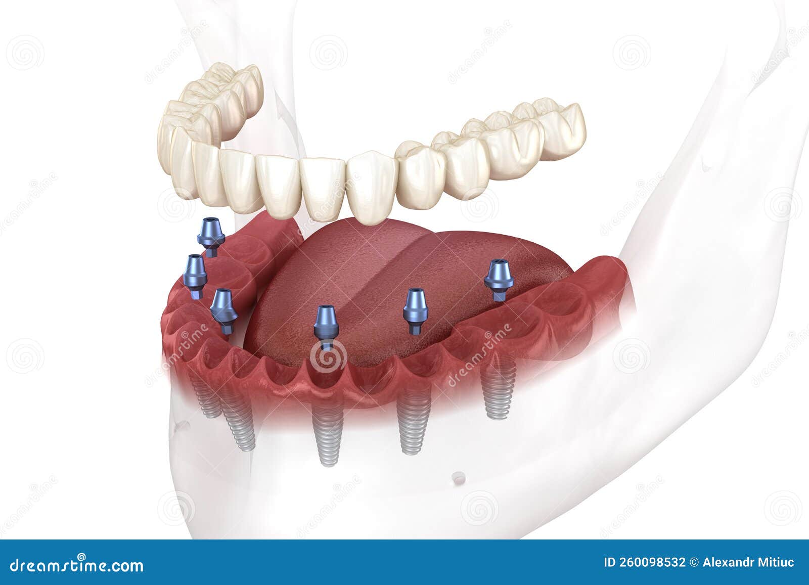 Removable Mandibular Prosthesis All on 6 System Supported by Implants ...