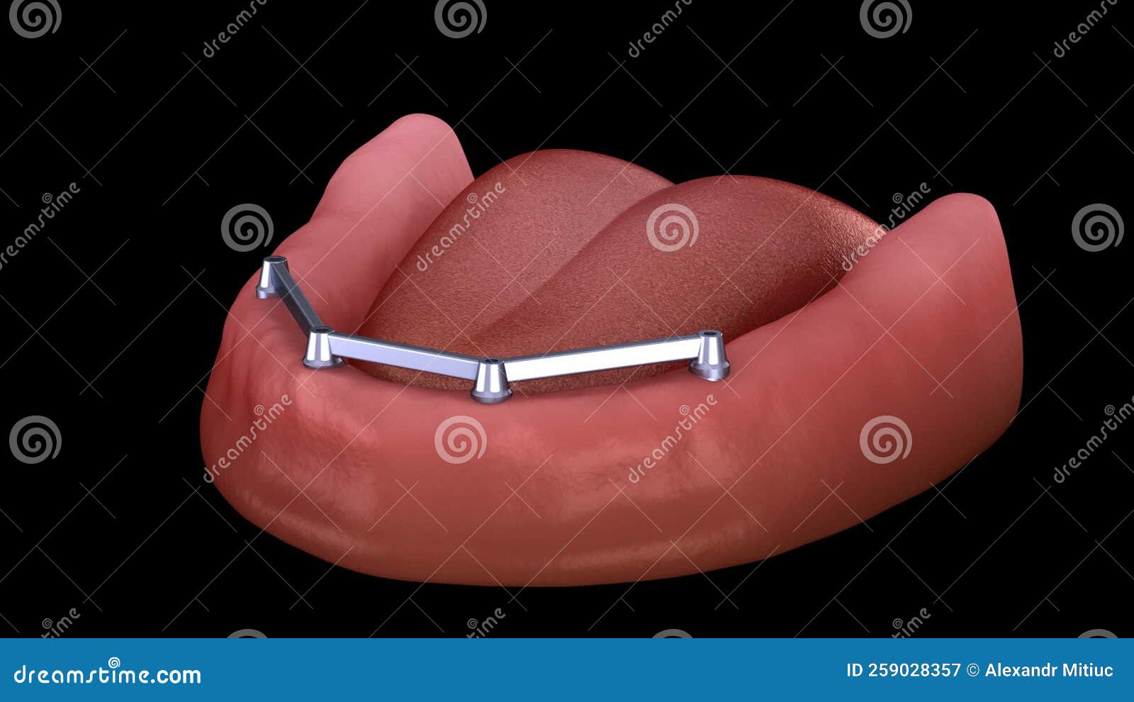 Removable Mandibular Prosthesis with Gum All on 4 System Supported by ...