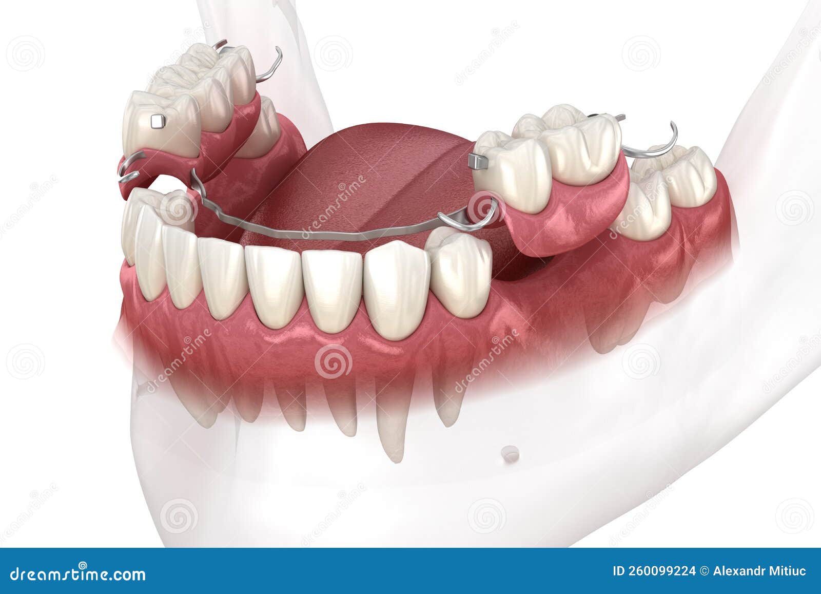 Removable Partial Denture, Mandibular Prosthesis. Medically Accurate 3D ...