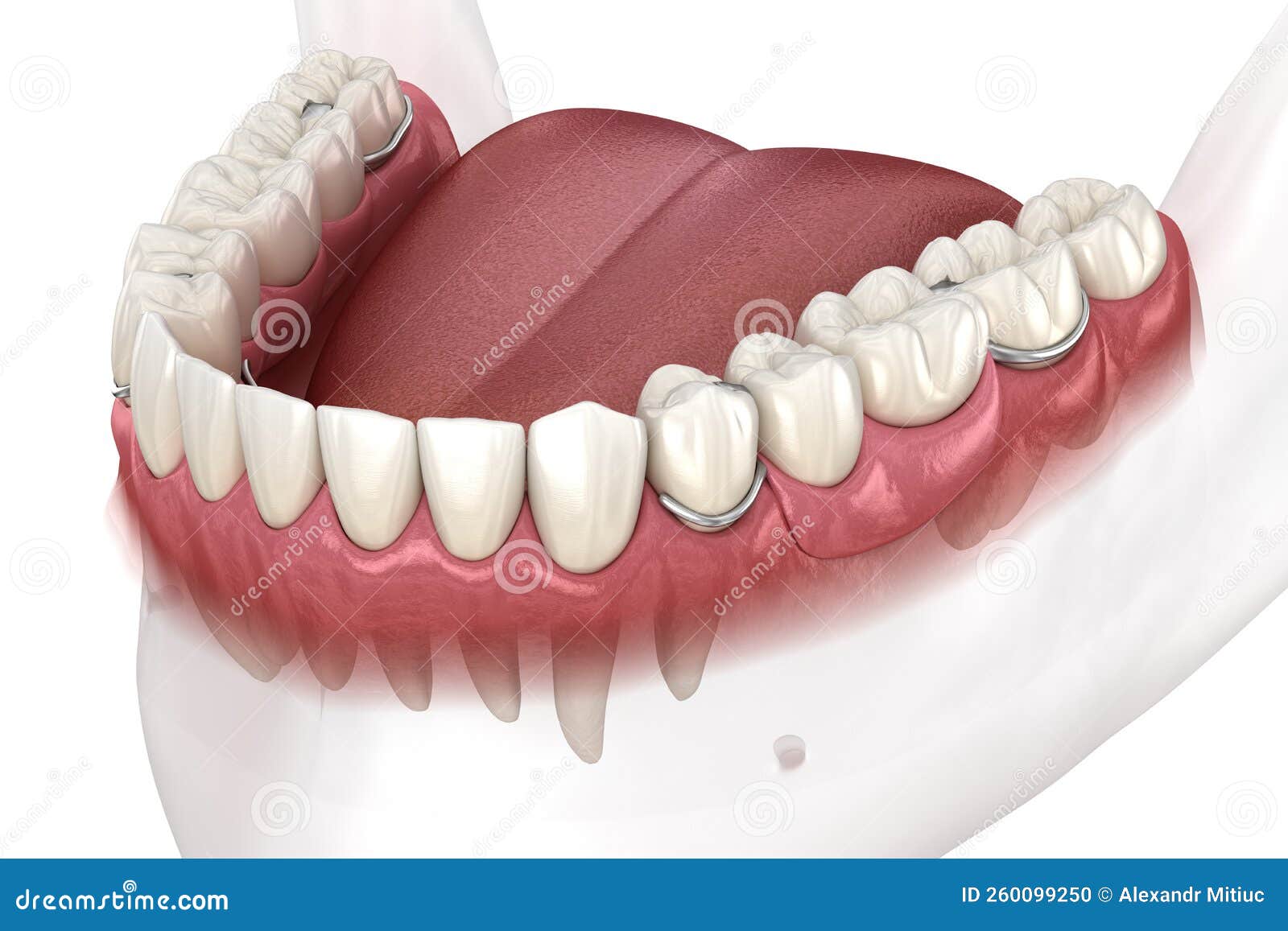 Removable Partial Denture, Mandibular Prosthesis. Medically Accurate 3D ...