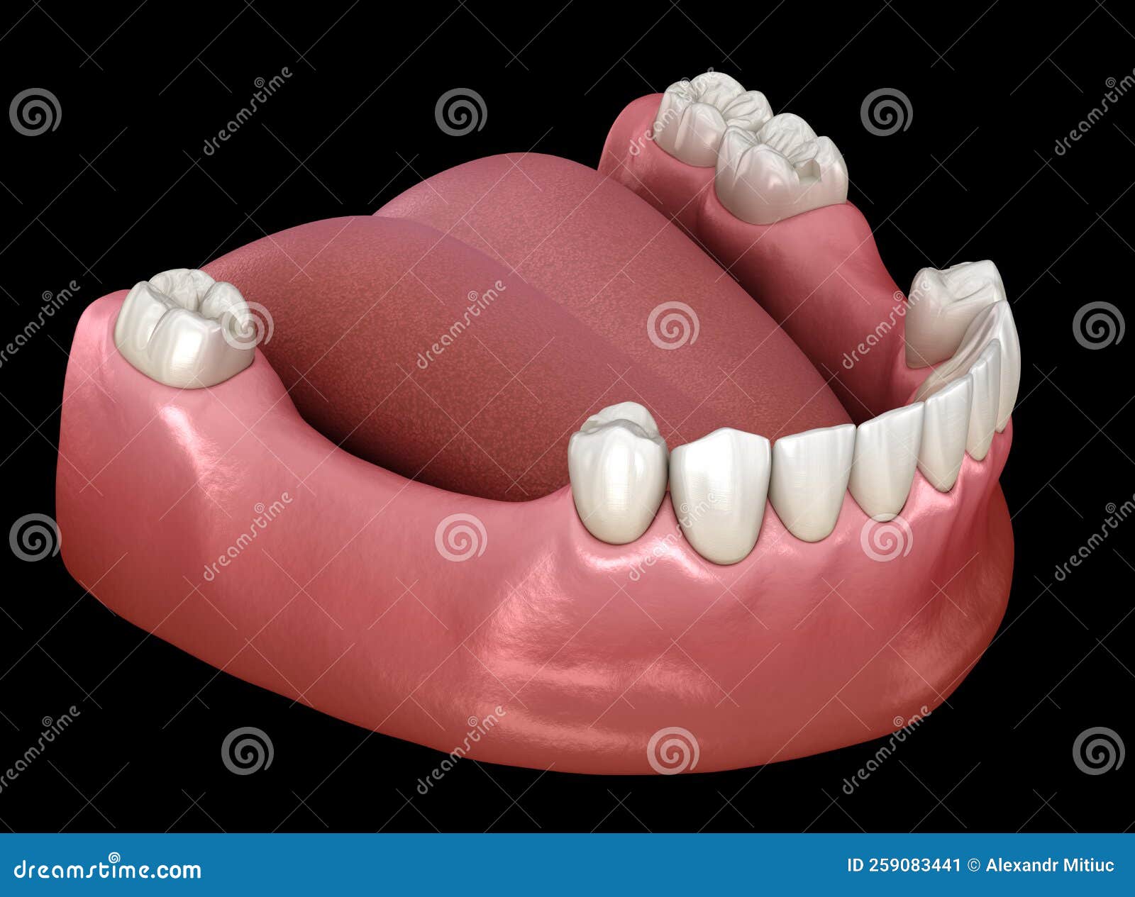 Removable Partial Denture Mandibular The Advantages Of