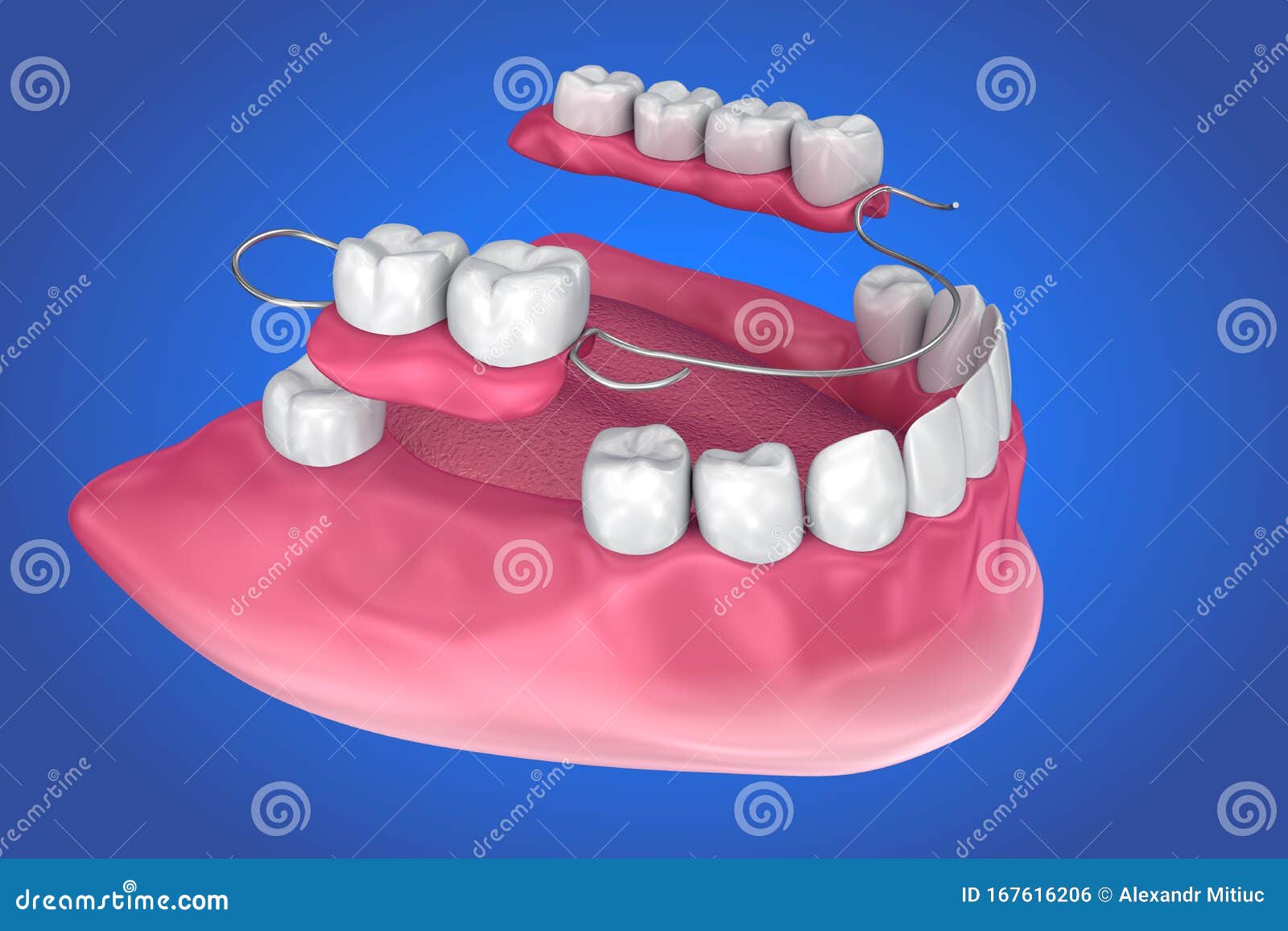 Partial Denture Transparent Icon. Partial Denture Symbol Design Cartoon ...