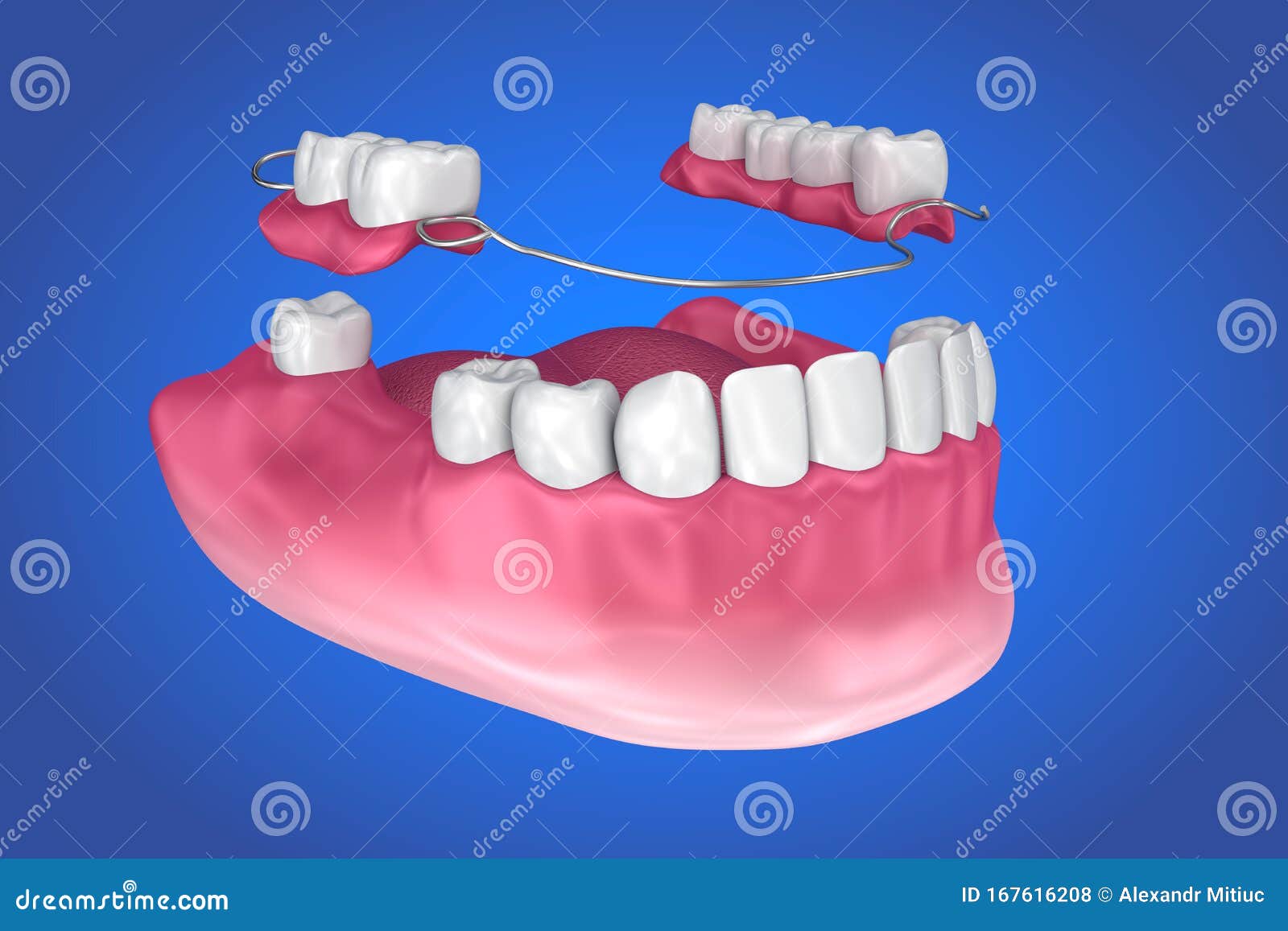 Removable Partial Denture, Mandibular Prosthesis. Medically Accurate 3D ...