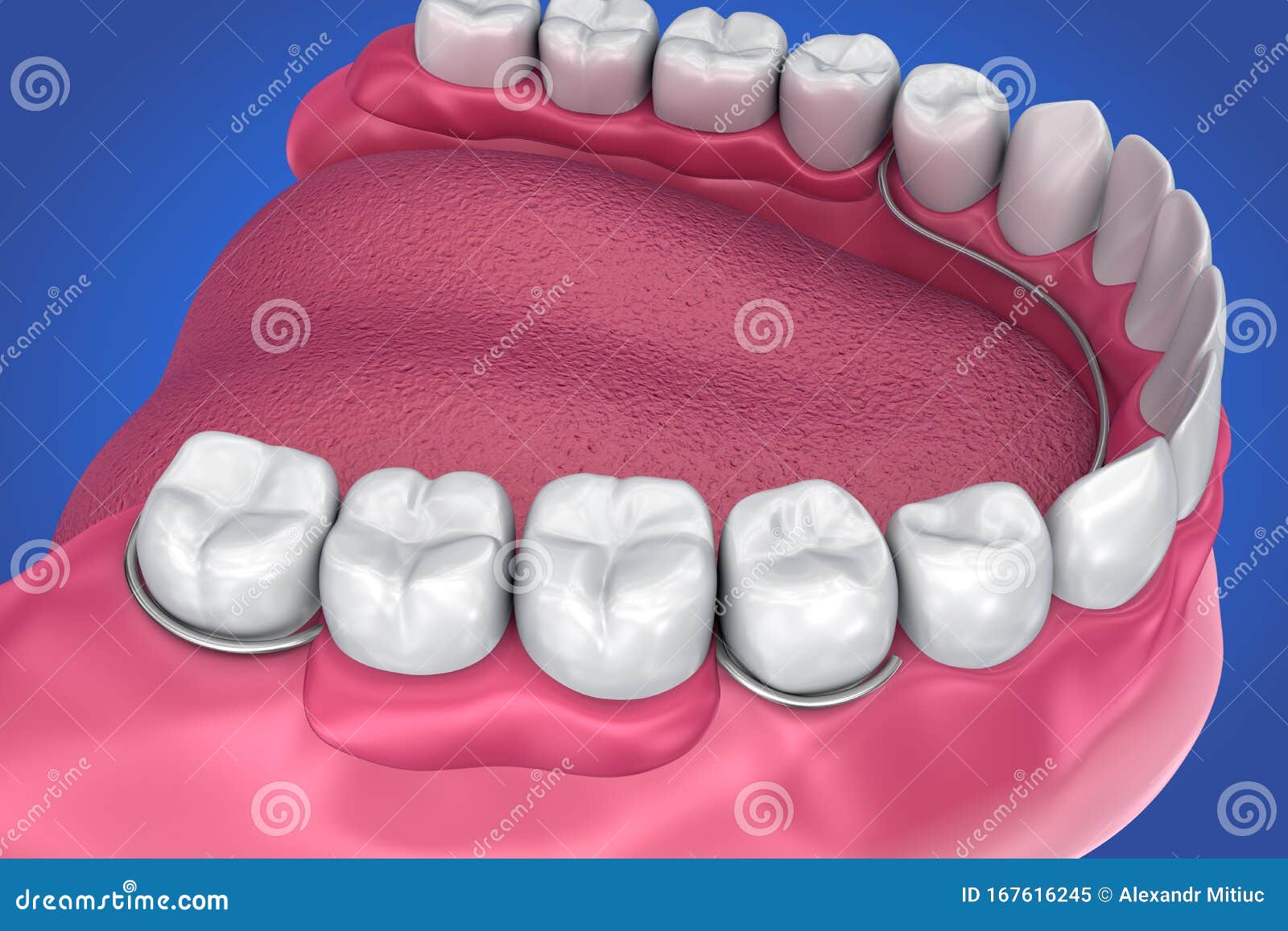 Removable Partial Denture, Mandibular Prosthesis. Medically Accurate 3D ...