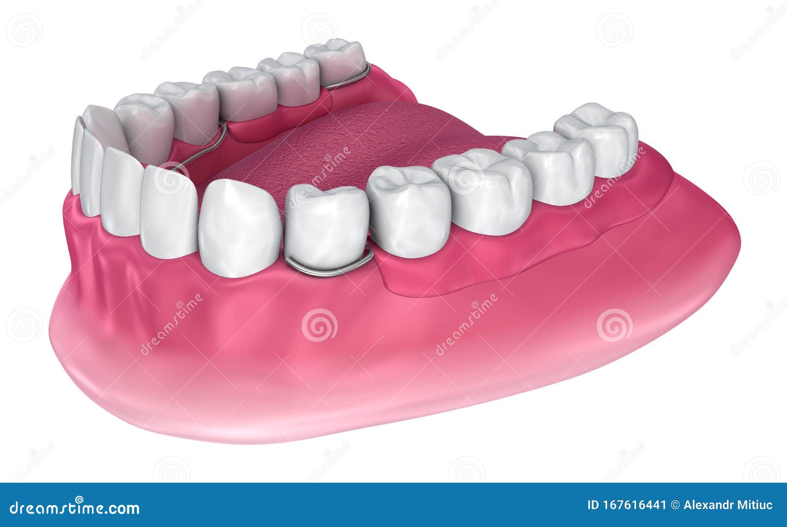 Removable Partial Denture. Medically Accurate Royalty-Free Cartoon ...