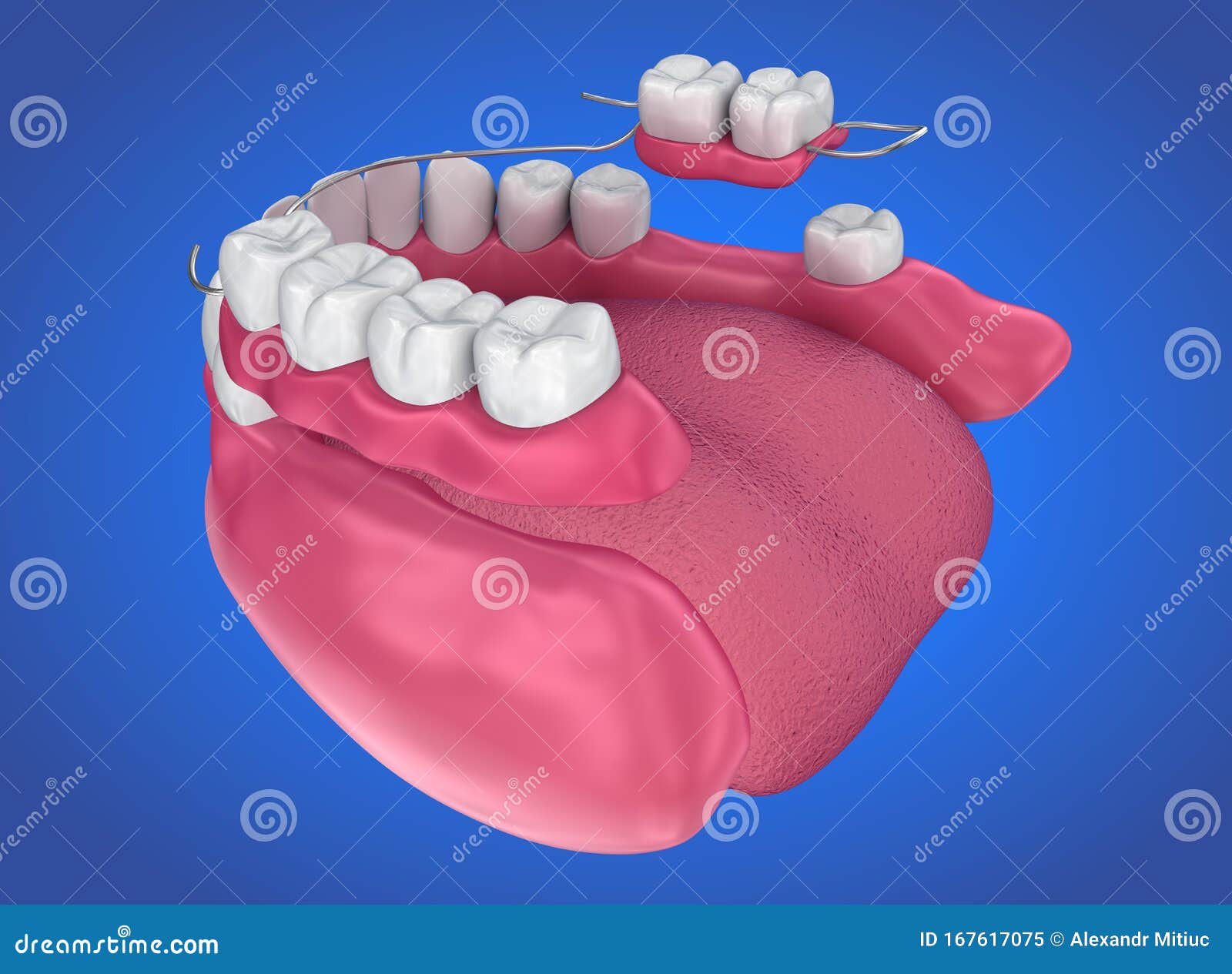 Removable Partial Denture. Medically Accurate Illustration Stock ...
