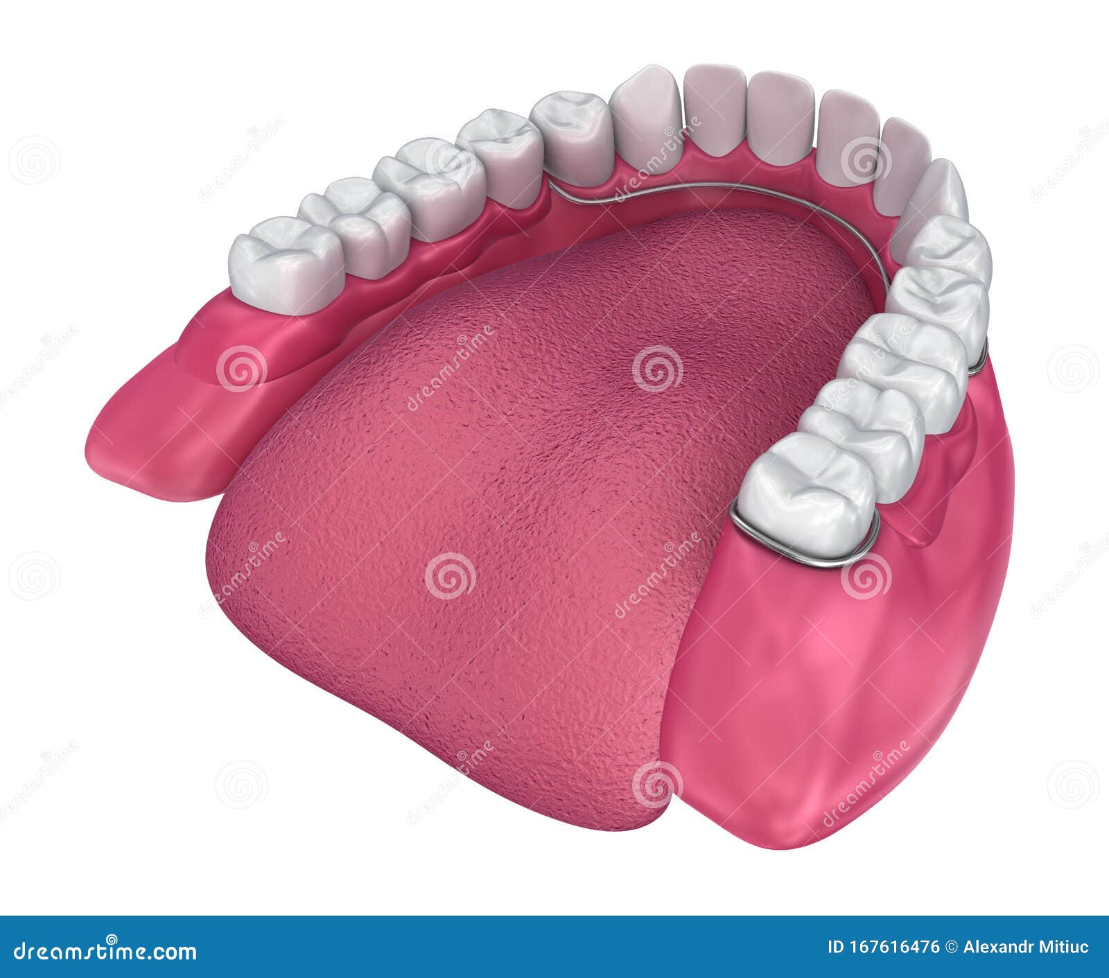 Removable Partial Denture. Medically Accurate Royalty-Free Cartoon ...