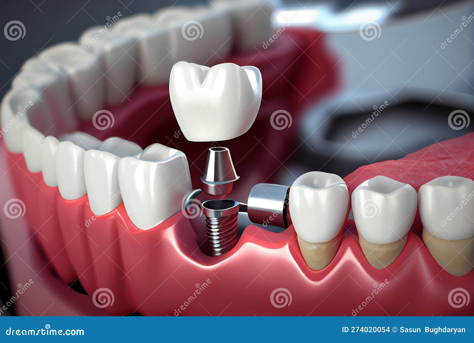 Removable Partial Denture. Medically Accurate Tooth.generative Ai Stock ...