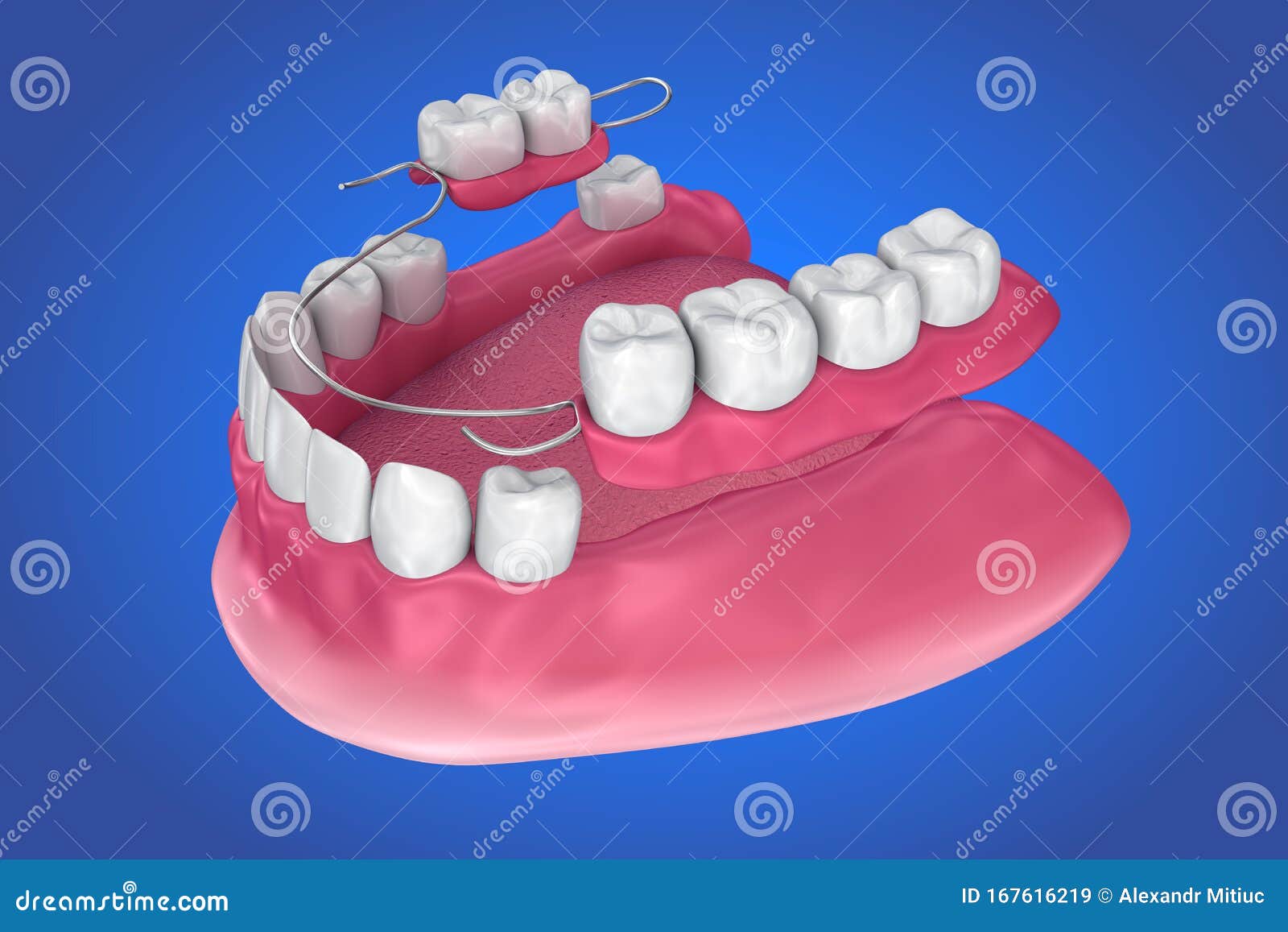 Removable partial denture. stock illustration. Illustration of ceramic ...
