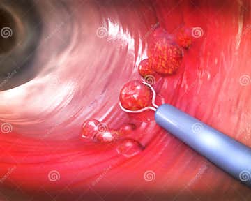 Removal of a Colonic Polyp with a Electrical Wire Loop during a ...