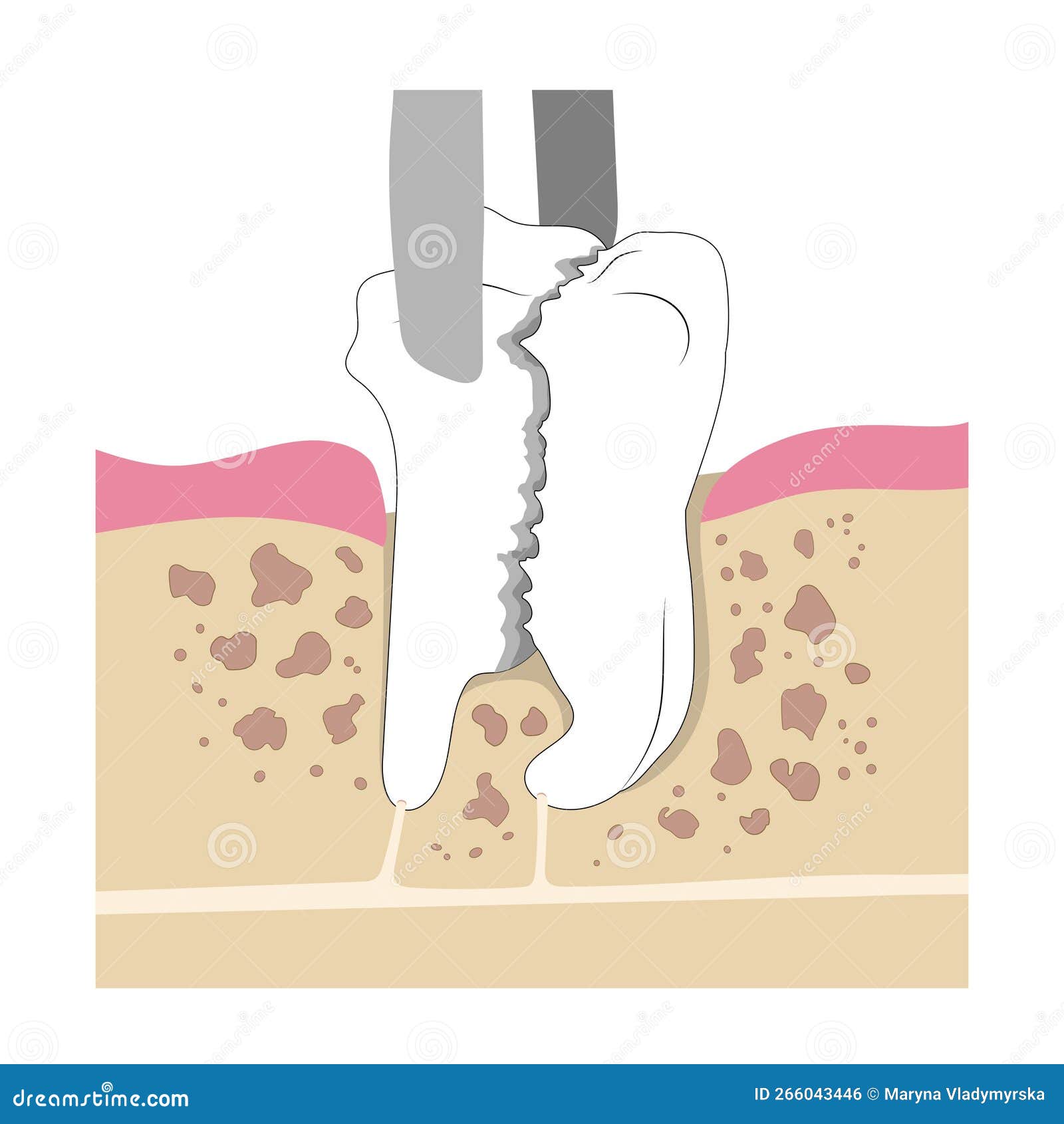 Process Of Carious Destruction Of Tooth Cartoon Vector | CartoonDealer ... Process Of Carious Destruction Of Tooth Cartoon Vector | CartoonDealer ...