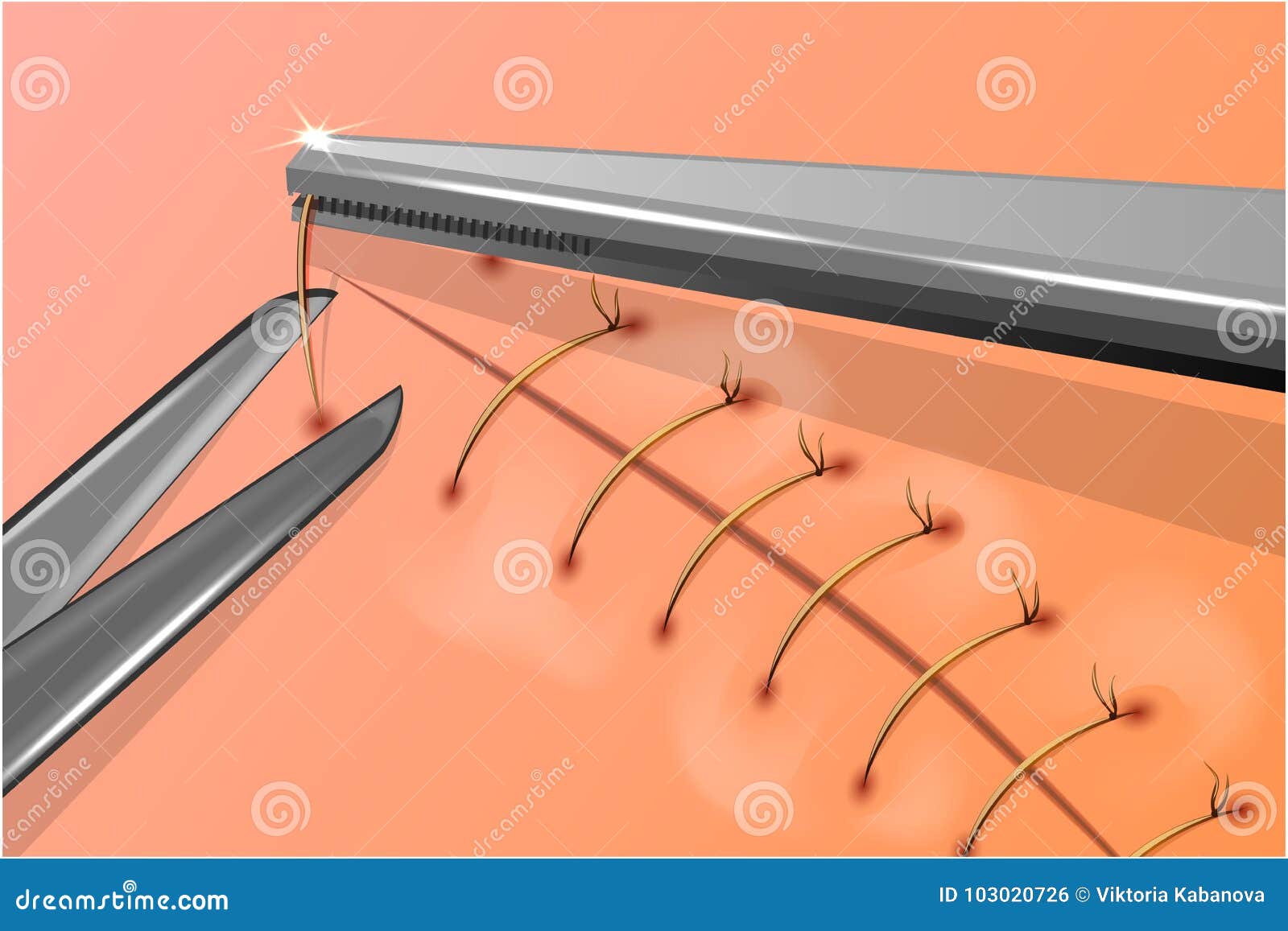 Removal of Surgical Stitches Stock Vector - Illustration of close ...