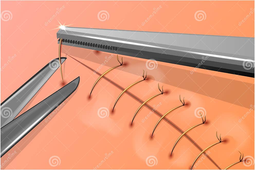 Removal of Surgical Stitches Stock Vector - Illustration of close ...
