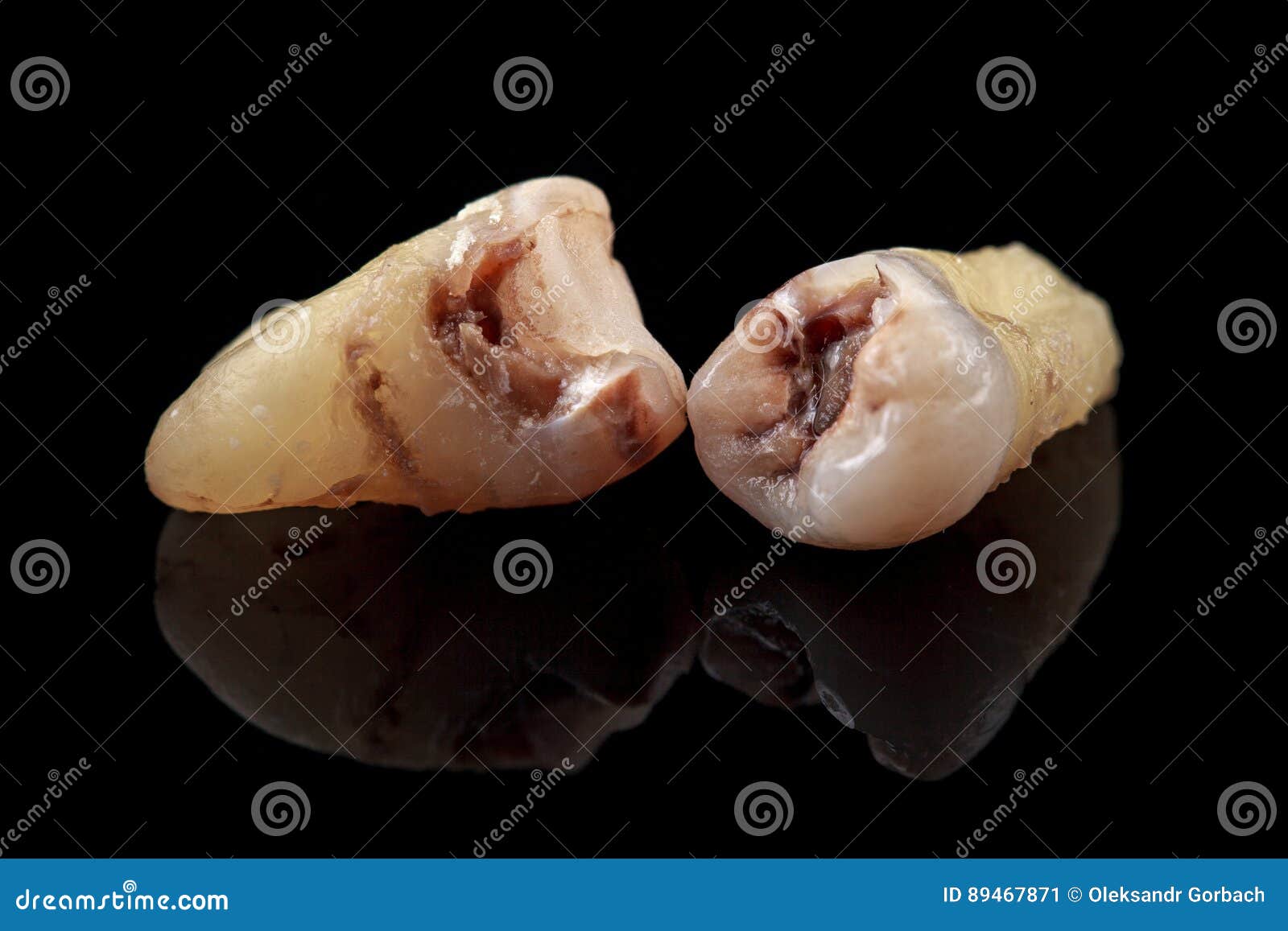 The Removed Teeth Damaged by Caries on a Black Background. Macro. Stock ...