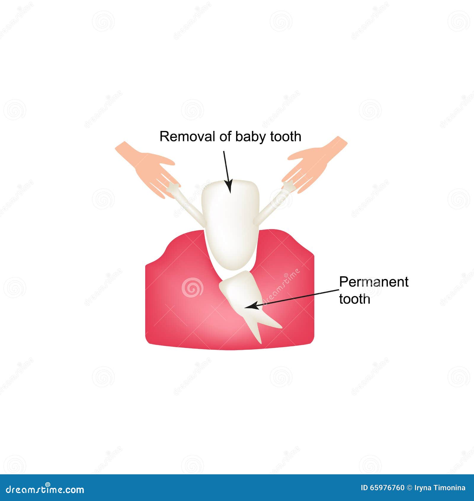 Removing Baby Teeth. Infographics Stock Vector - Illustration of dental ...
