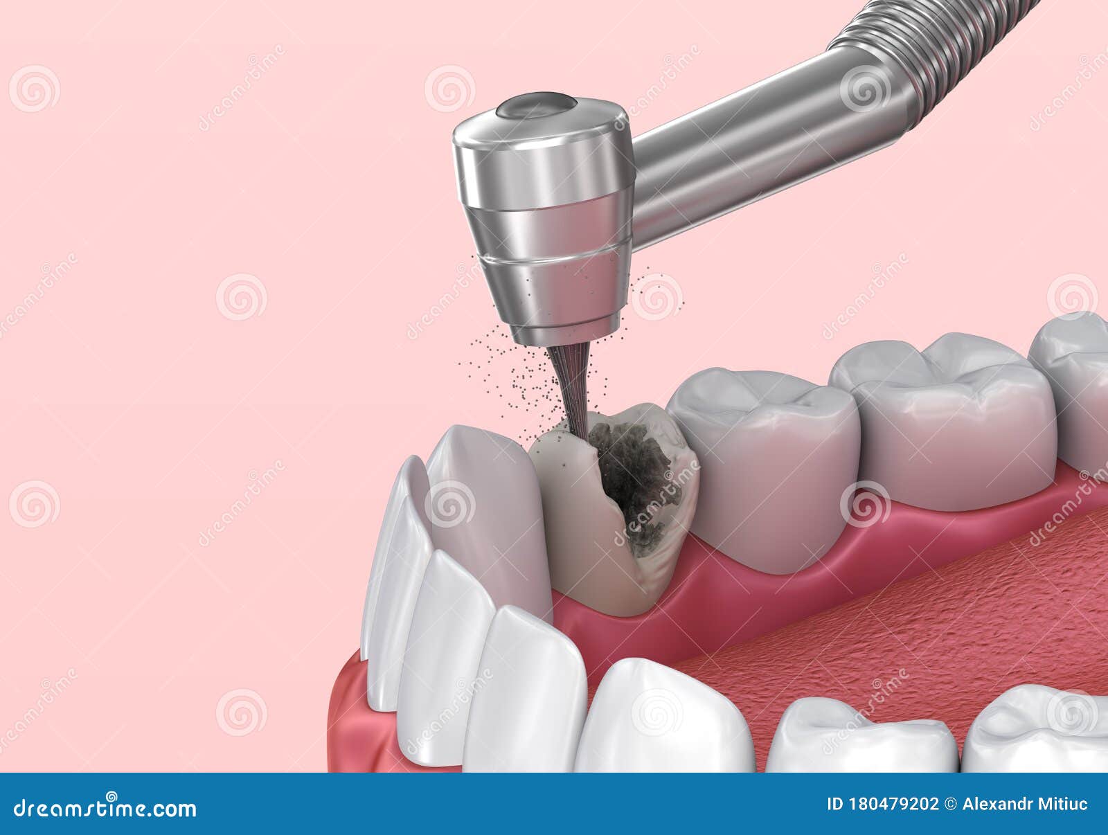 Removing The Caries Medically Accurate Tooth Illustration Stock