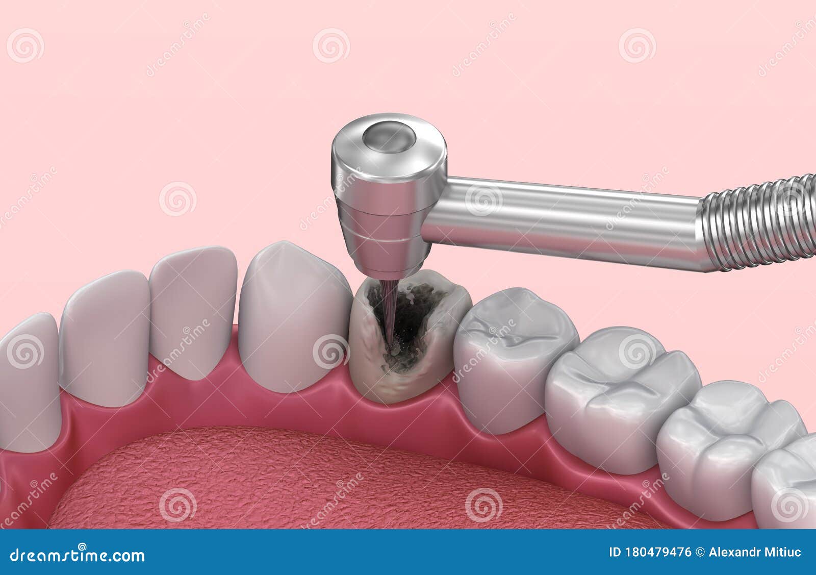 Removing the Caries . Medically Accurate Tooth Illustration Stock ...