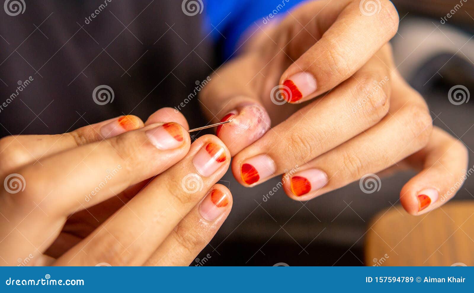 Wound Infection On The Skin. A Wound On The Human Body, Suture Old ...