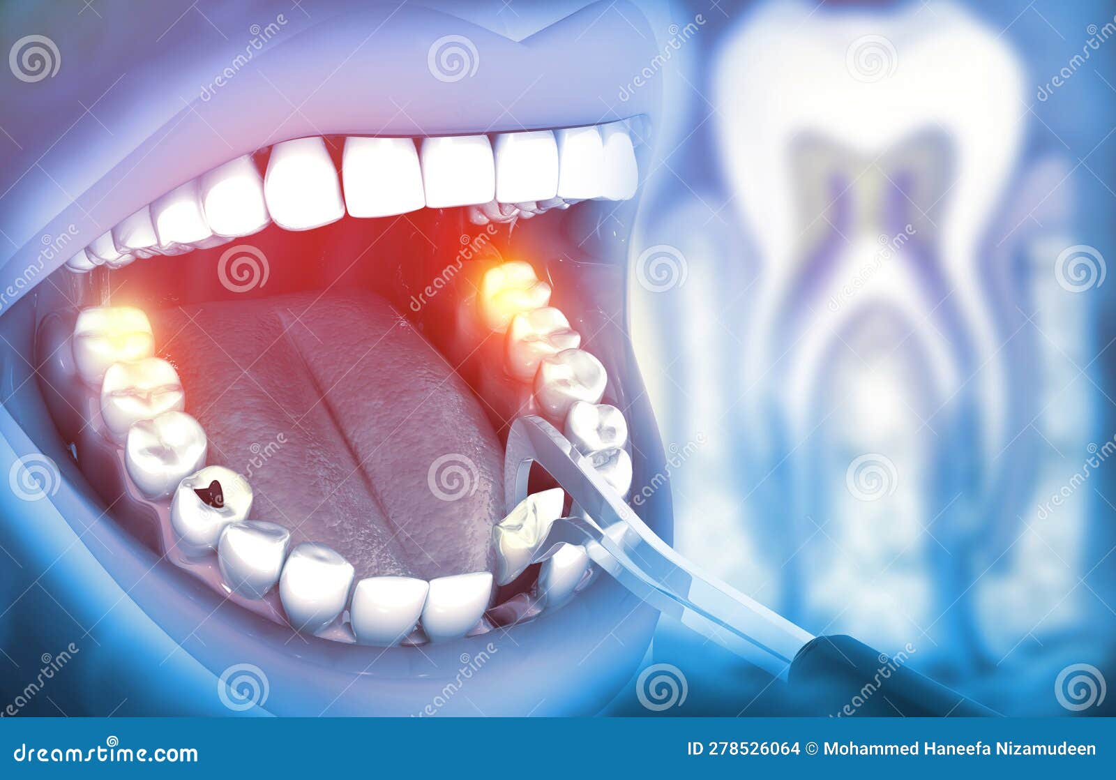 Removing the sick tooth stock illustration. Illustration of sick ...
