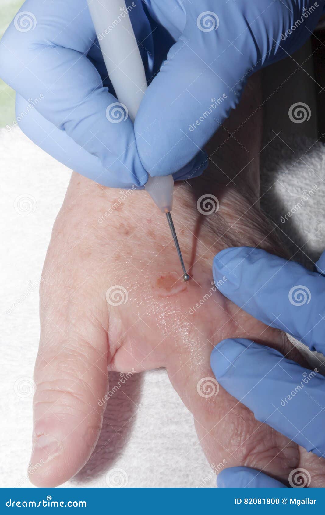 Removing skin diseases stock photo. Image of microsurgery - 82081800